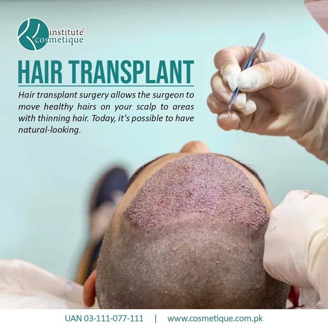 Hair Transplant In Pakistan Lahore Karachi Islamabad