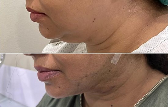 Liposuction in Lahore, Pakistan Using The Latest Tumescent Technique