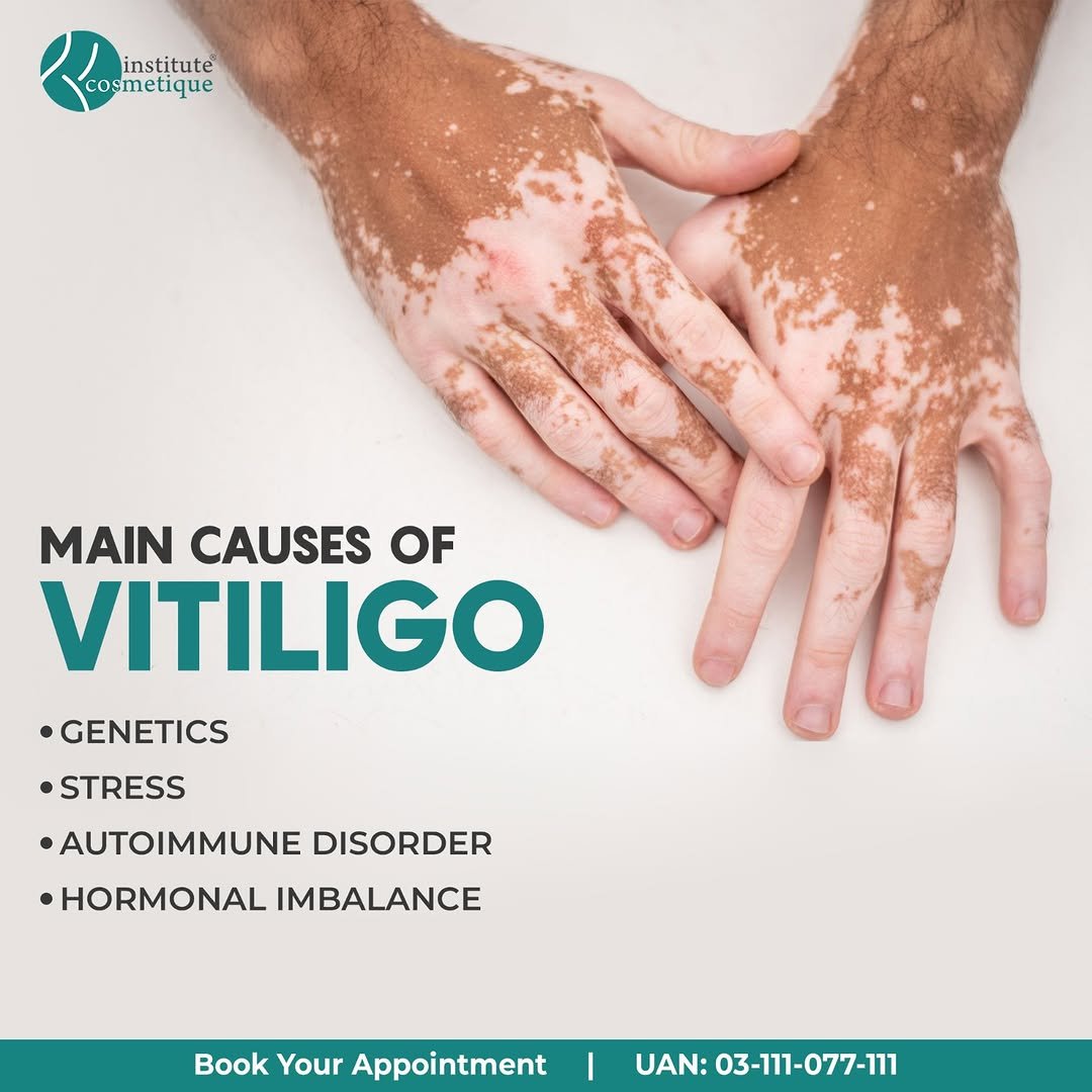 Best Vitiligo Treatment in Lahore – Cosmetique Clinic